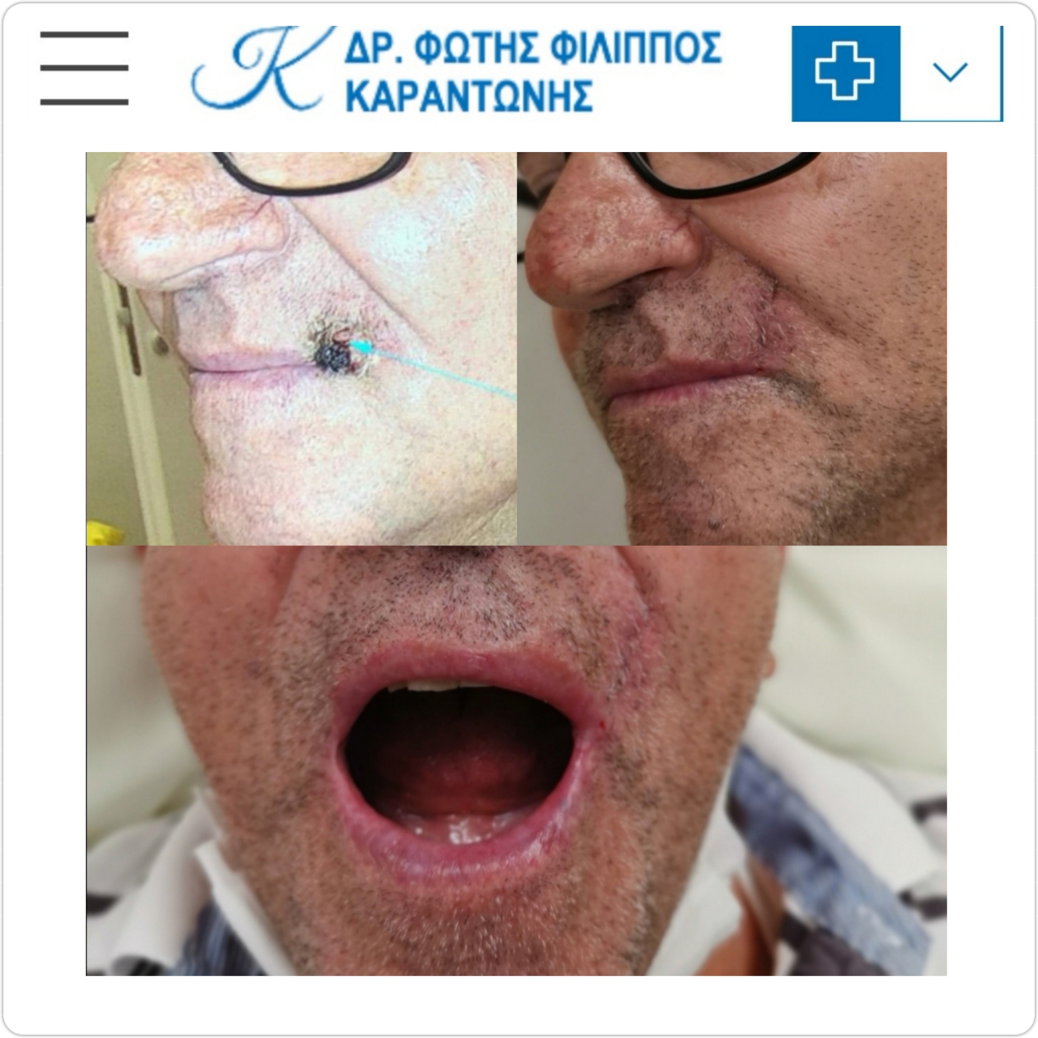 Καρκίνος του δέρματος - Μελάνωμα - Πλαστικός Χειρουργός