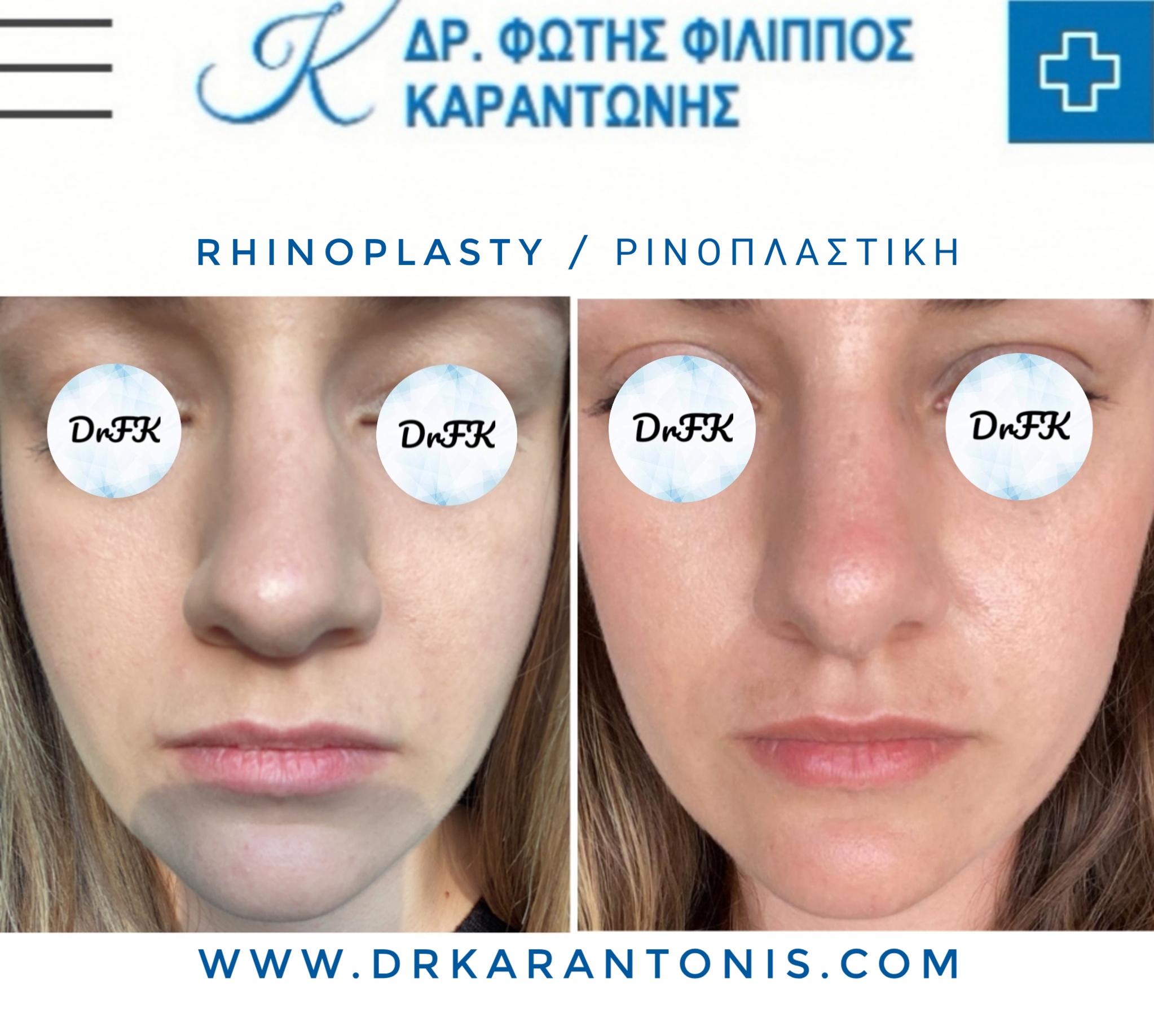 Rhinoplasty and Liquid rhinoplasty - Πλαστικός Χειρουργός