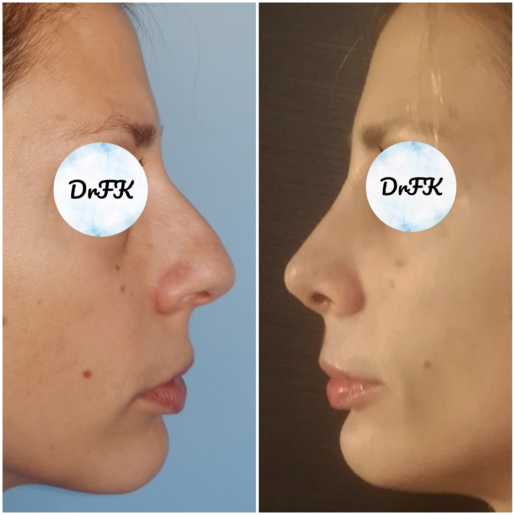 Rhinoplasty and Liquid rhinoplasty - Πλαστικός Χειρουργός